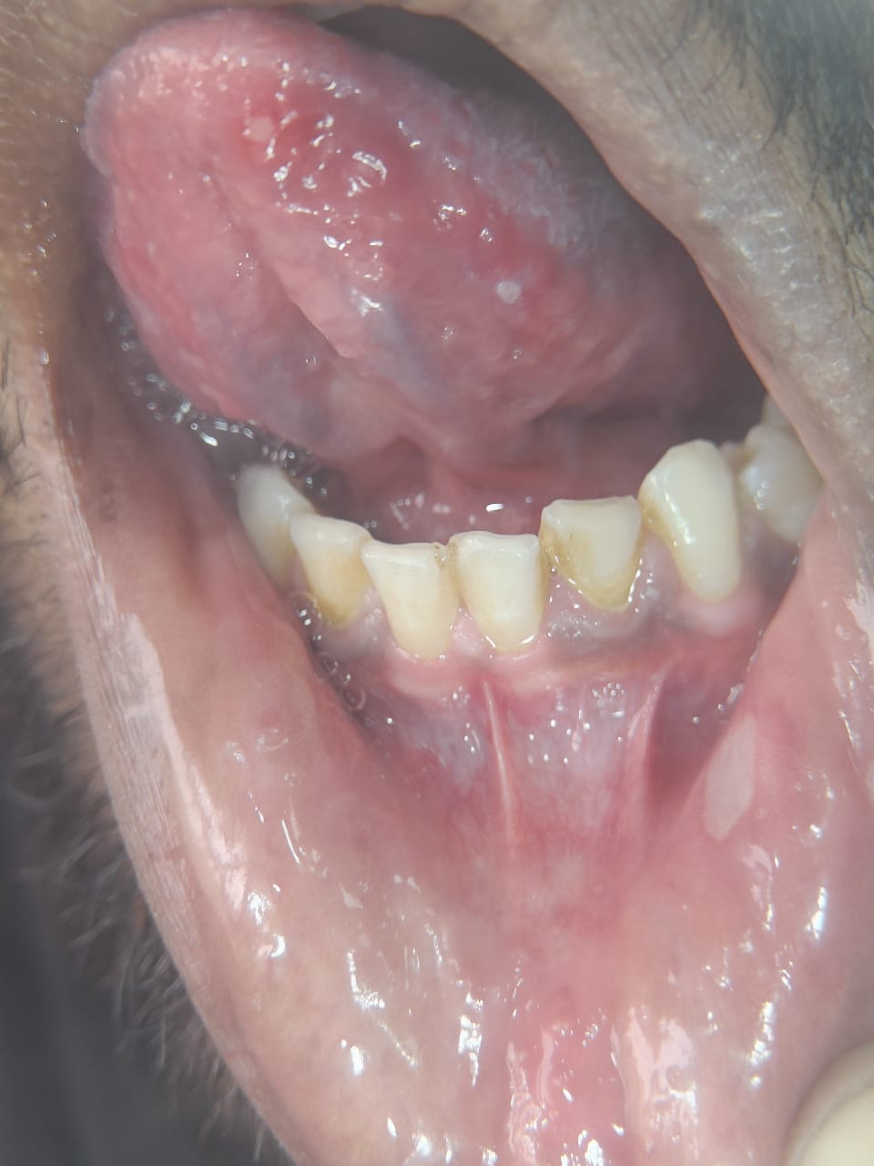 Mouth Ulcer Instance Segmentation Model (v1, 2022-08-02 4:42pm) by Ulcer Segmentation