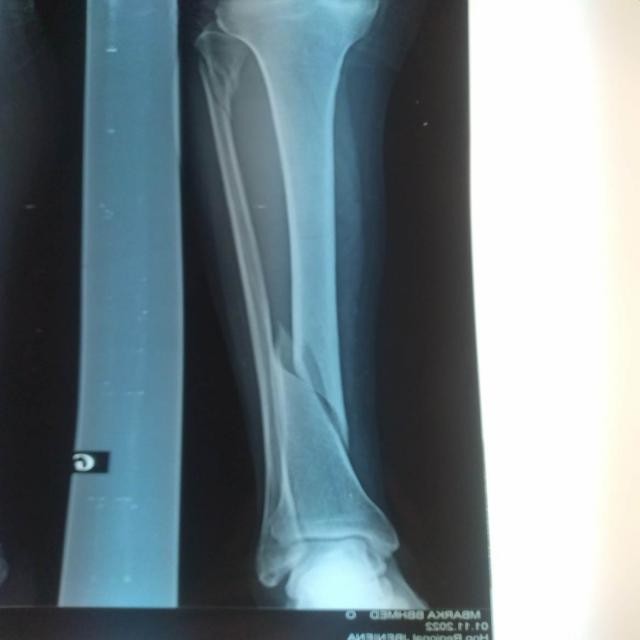 Bone Fracture Object Detection Model by eliza