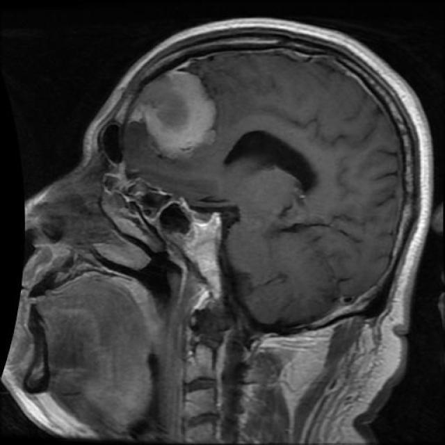 brain-tumor Instance Segmentation Model by eliza