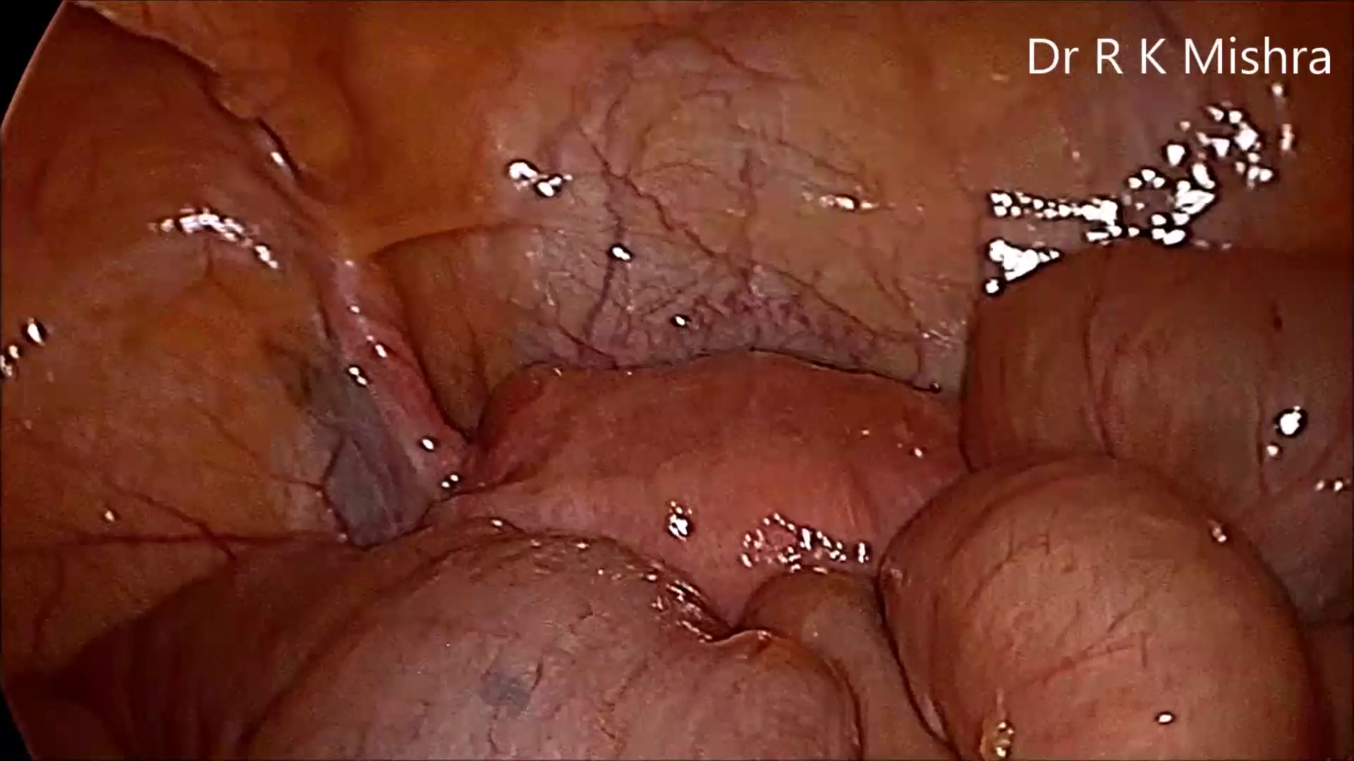 Uterus And Tool Detection Object Detection Dataset And Pre Trained