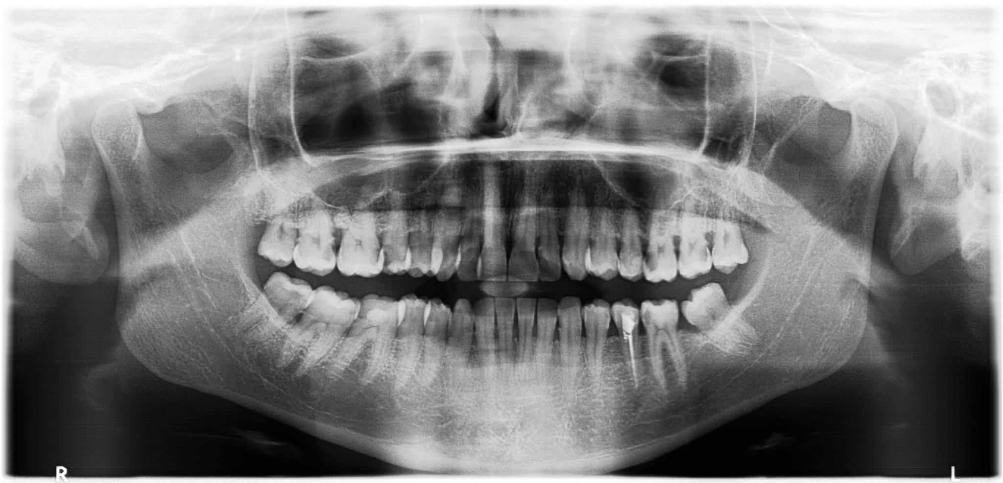 Dental Object Detection Model by XenoDentPanoramic