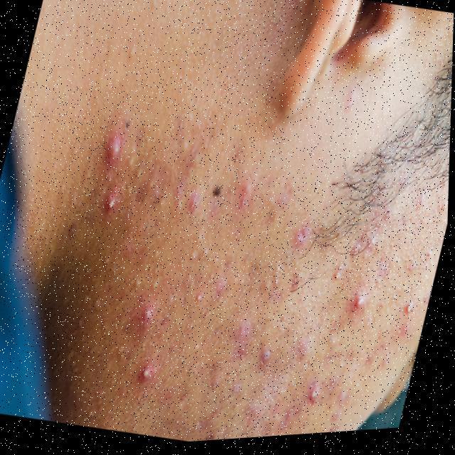 acne Object Detection Dataset by kiky