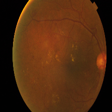 DR_Model_2 Object Detection Dataset by opticaldisk