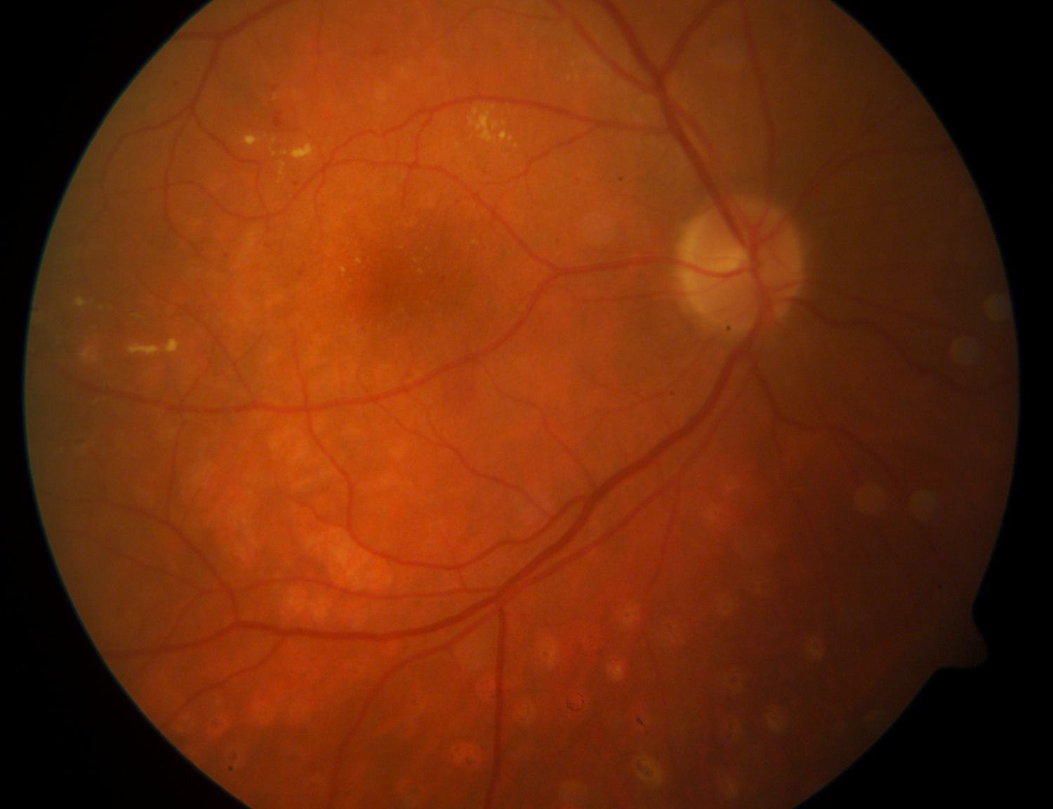 Exudates Object Detection Model By Opticaldisk