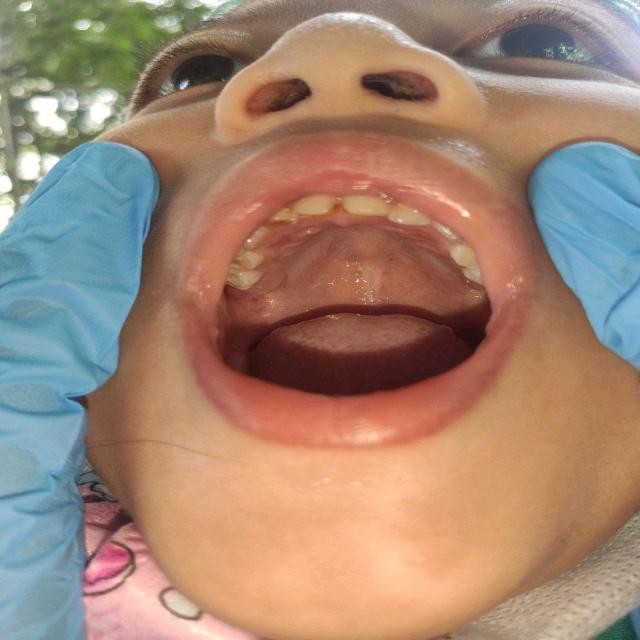 Caries Classification Icdas Ii 2 Object Detection Dataset And Pre Trained Model By Code Geass