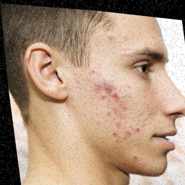 Yolov8 Acne Detection Object Detection Dataset And Pre Trained Model By