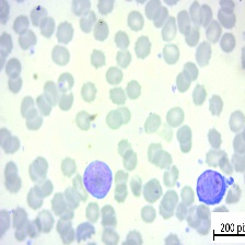 Leukemia Object Detection Model by Annotation