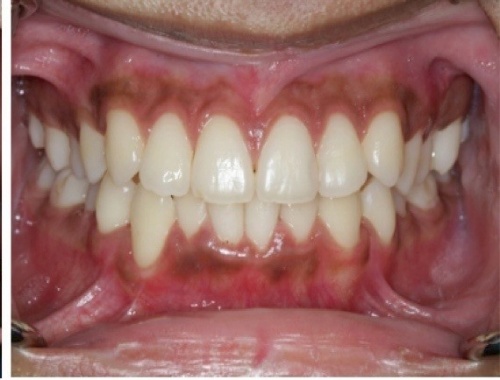 Calculus Detection Object Detection Model by DraftIdea