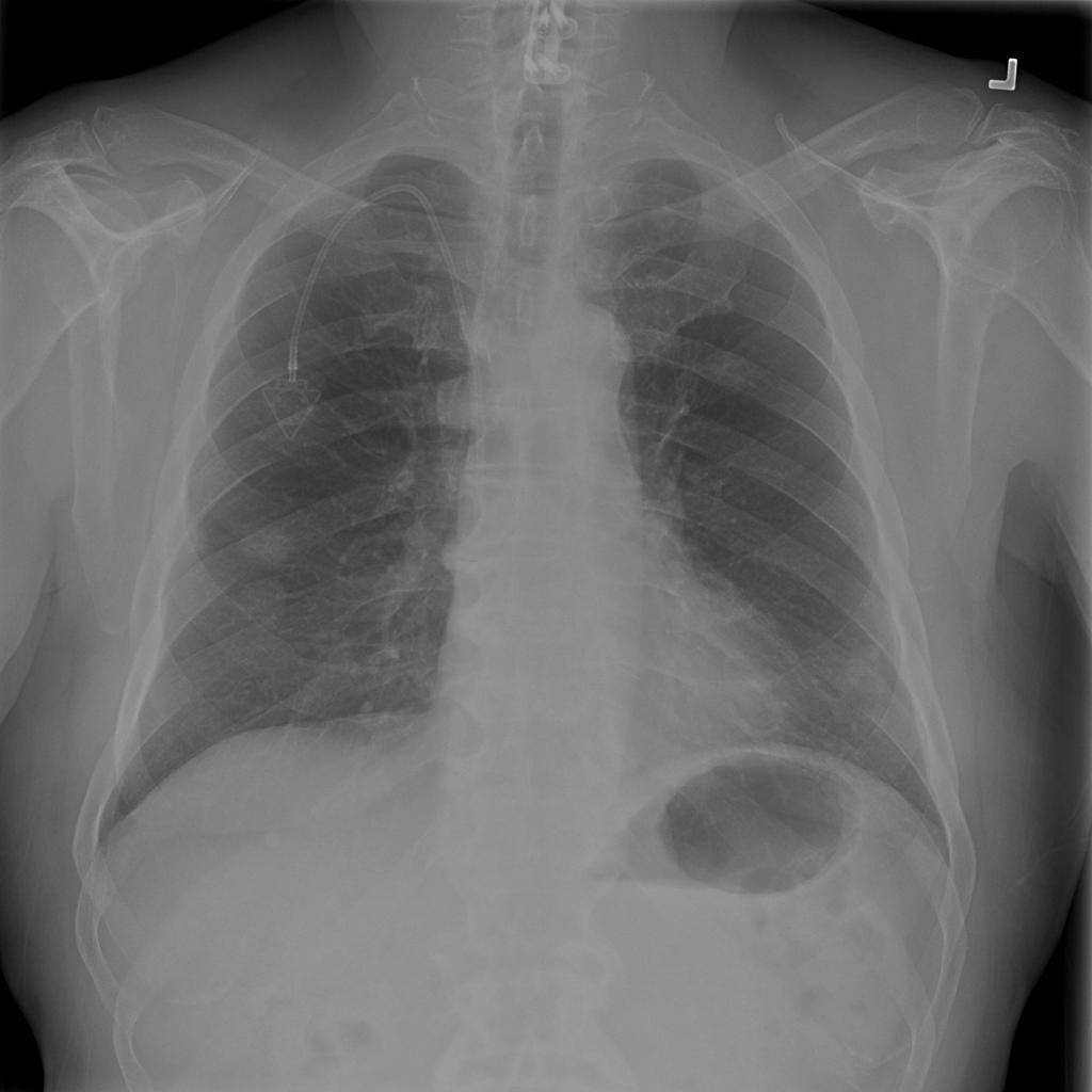 tumor detect Object Detection Dataset by Yahia