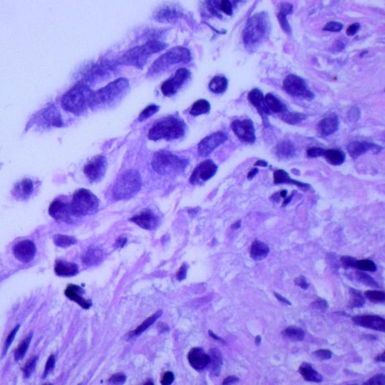 Lung Cancer Classification Classification Dataset By Pjt