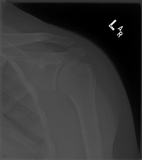 Bone Fracture Object Detection Dataset by Benjawan