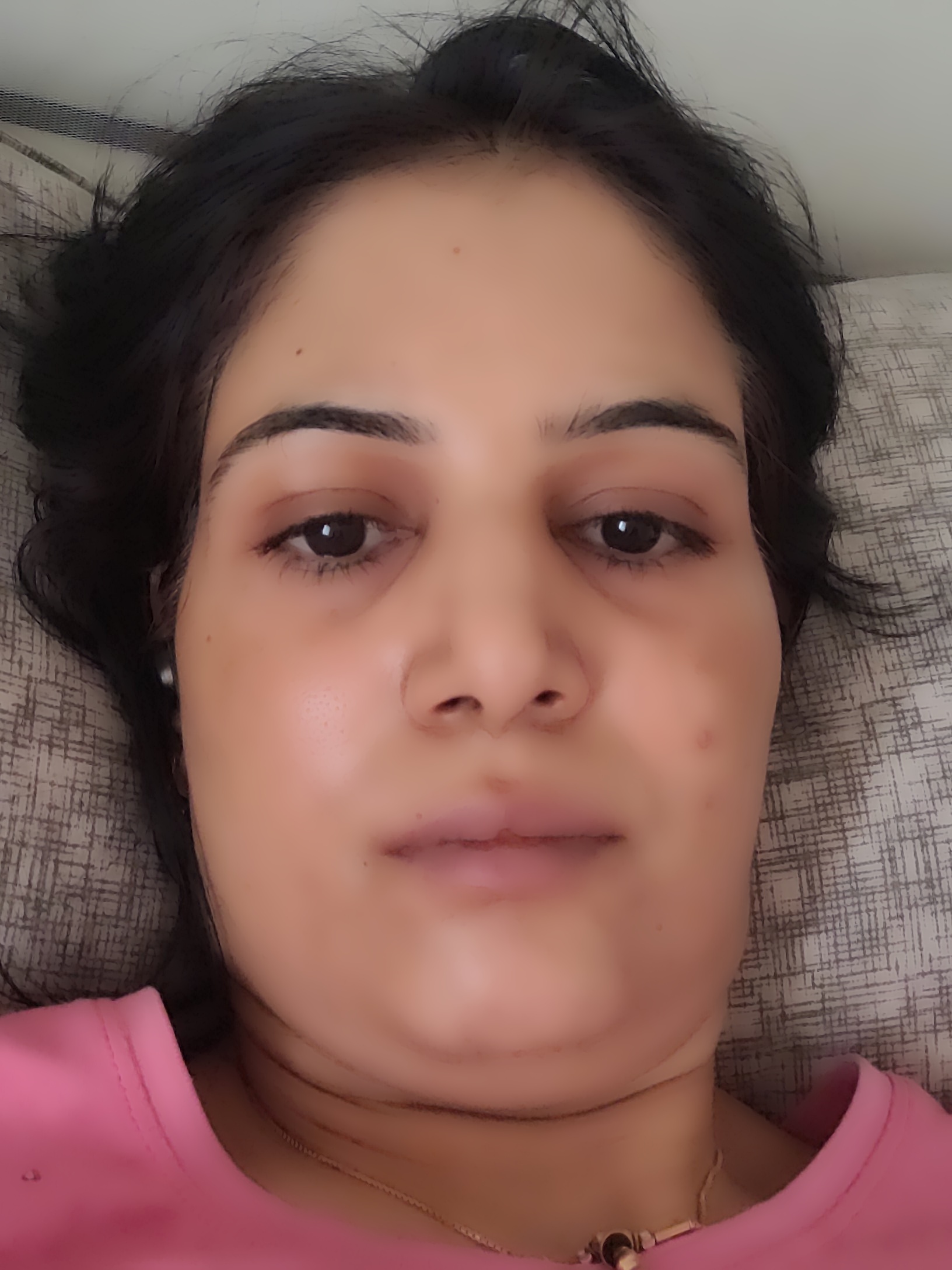 Acne Marks Batch 14 Dataset Object Detection Dataset By Rizwan