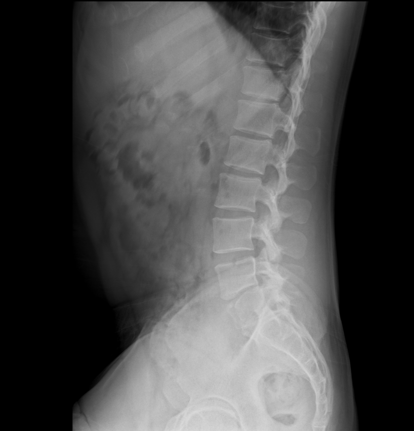 lumbar spine x ray Instance Segmentation Dataset by afterpain