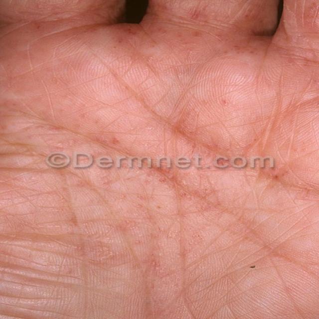 skin disease Object Detection Model by corrosion