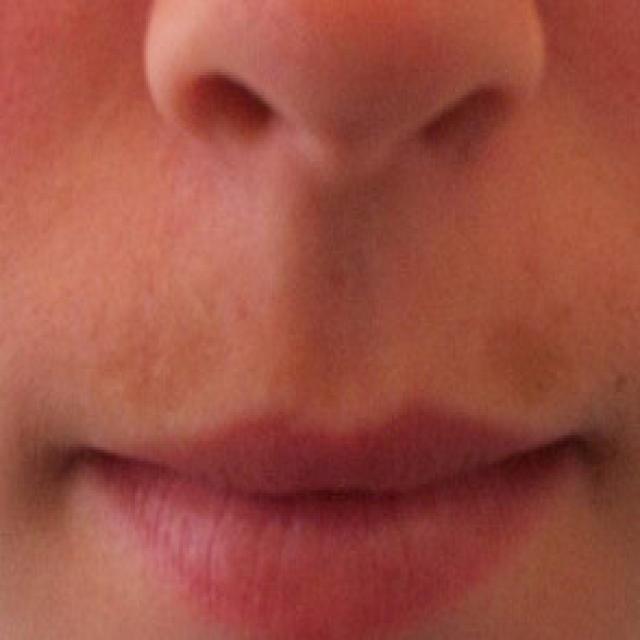 face dark spots Instance Segmentation Dataset by wajeeha shafique