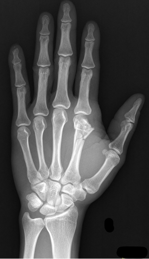 Scaphoid-scanner Object Detection Model by Augusto Cesar