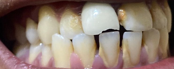 How to Use the tooth detector2 Object Detection API