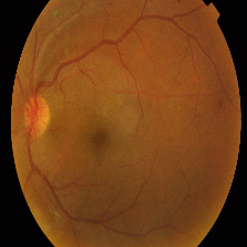 blindness detection Classification Dataset by Beyda