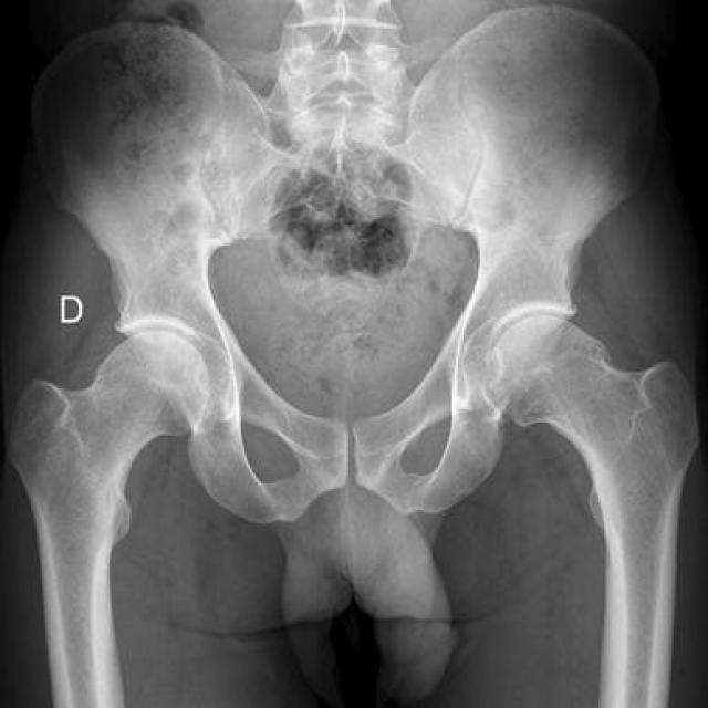 bone_1 Instance Segmentation Dataset by moke