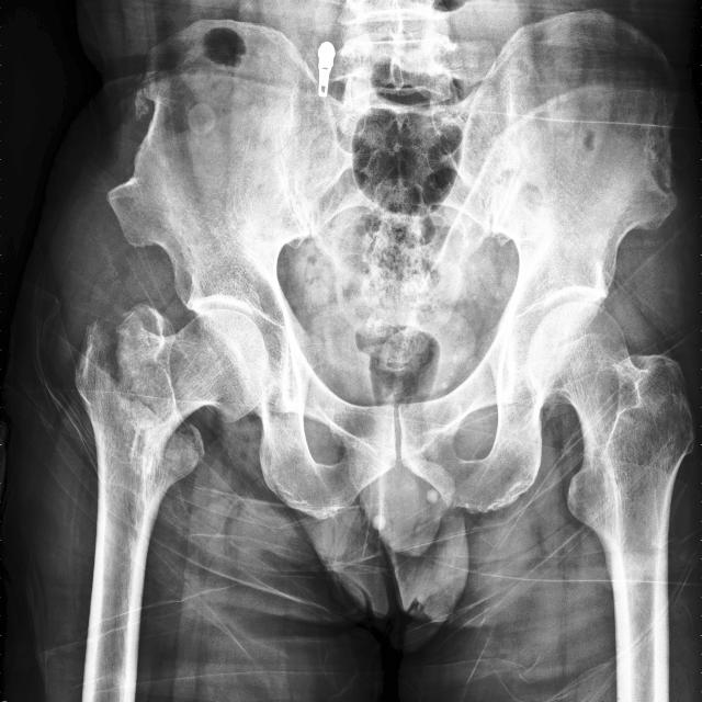 bone_2 Instance Segmentation Model by moke