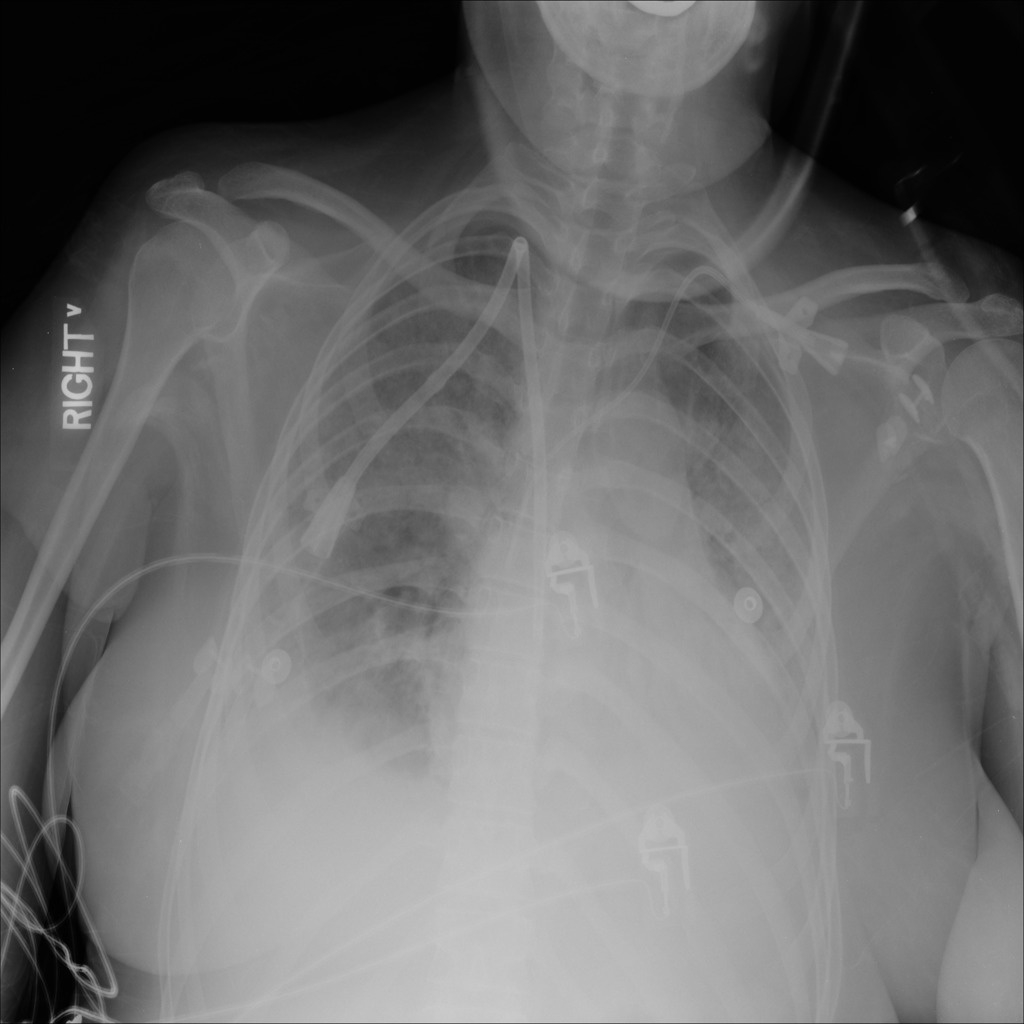 'Pneumonia' Object Detection Model by yolo
