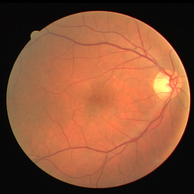 Retinal Segmentation Instance Segmentation Dataset And Pre Trained Model By Development Of A