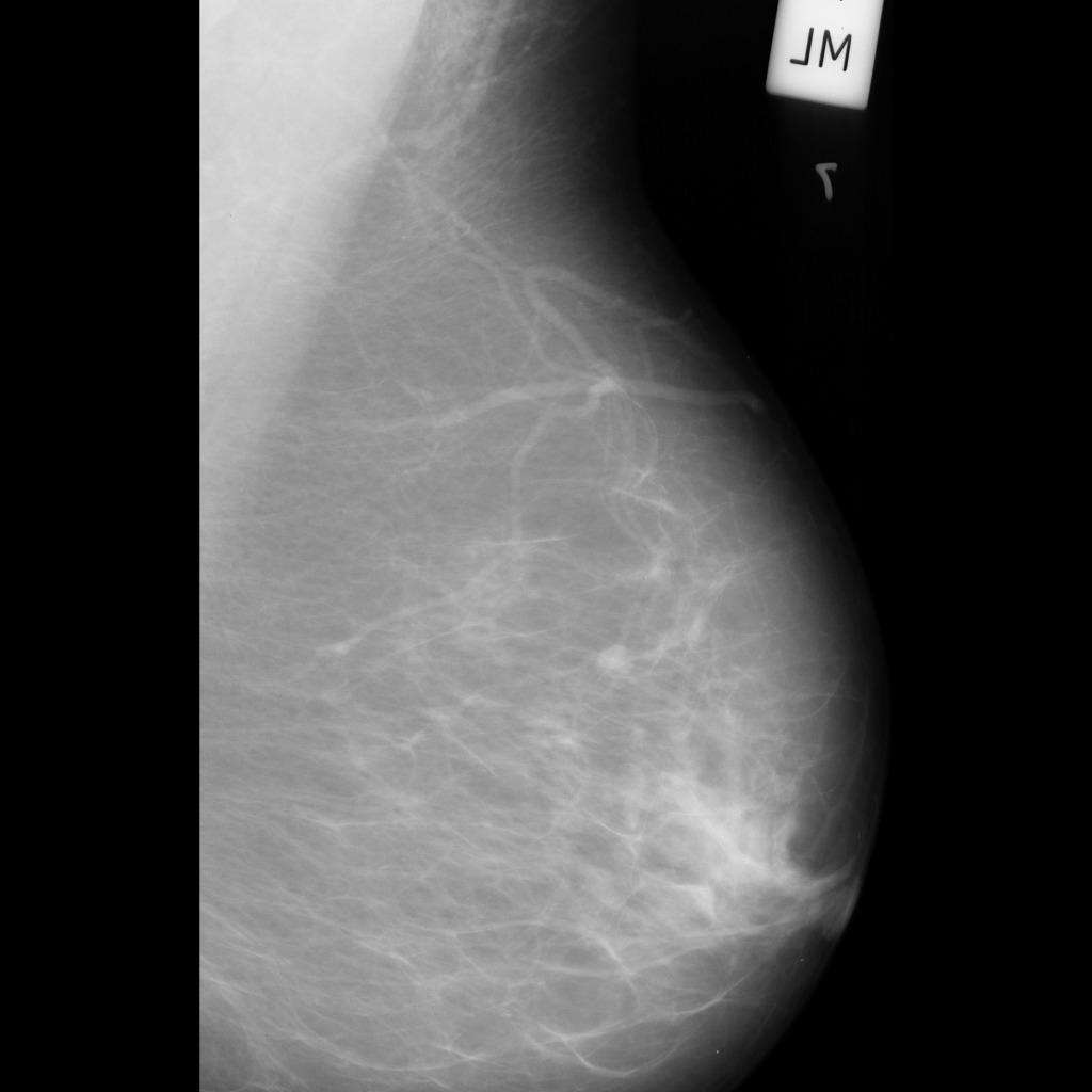 Breeast Cancer detection Classification Dataset by LearningAI