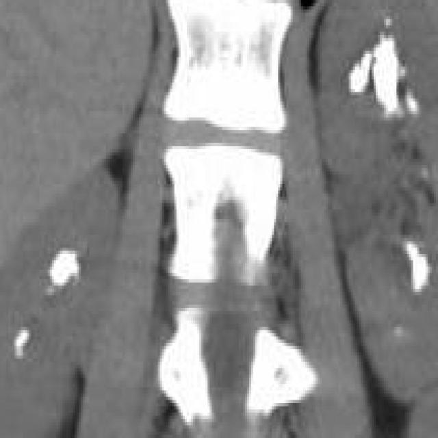 Renal tumor segmentation Instance Segmentation Dataset and Pre-Trained Model by popraulworkspace