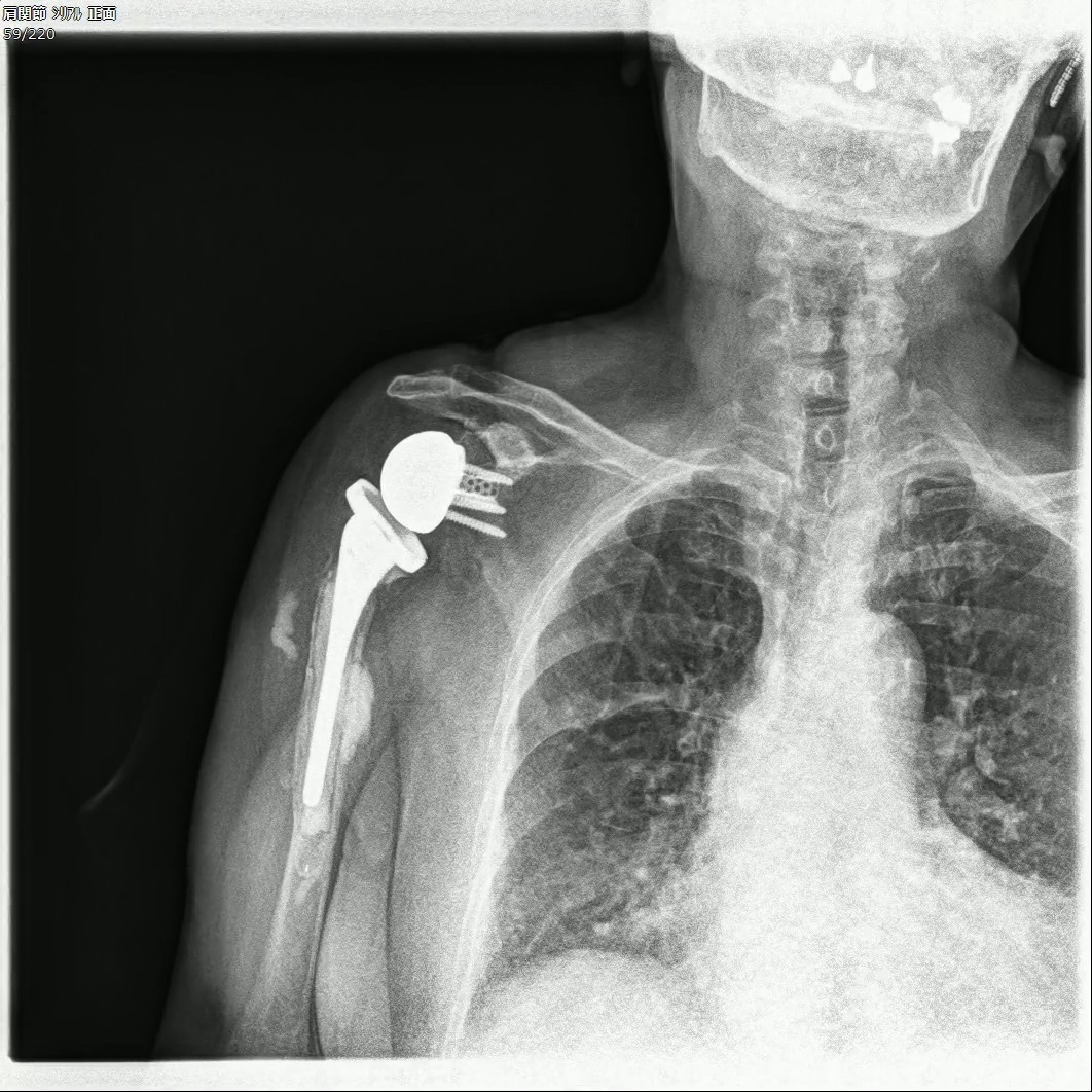 My First Project Keypoint Detection Model by shoulder estimate