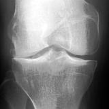 Osteoarthritis label Classification Model by Iti