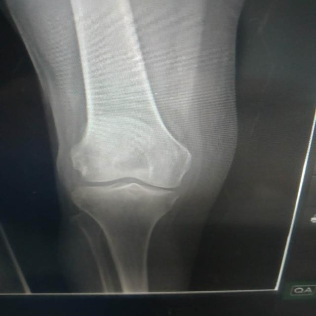BONE FRACTURE CLASSIFICATION Object Detection Dataset and Pre-Trained ...