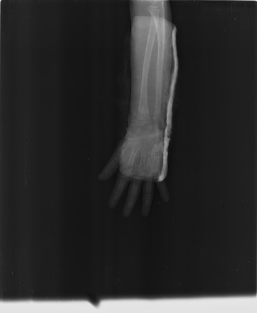 Bone Fractures Instance Segmentation Dataset by mine