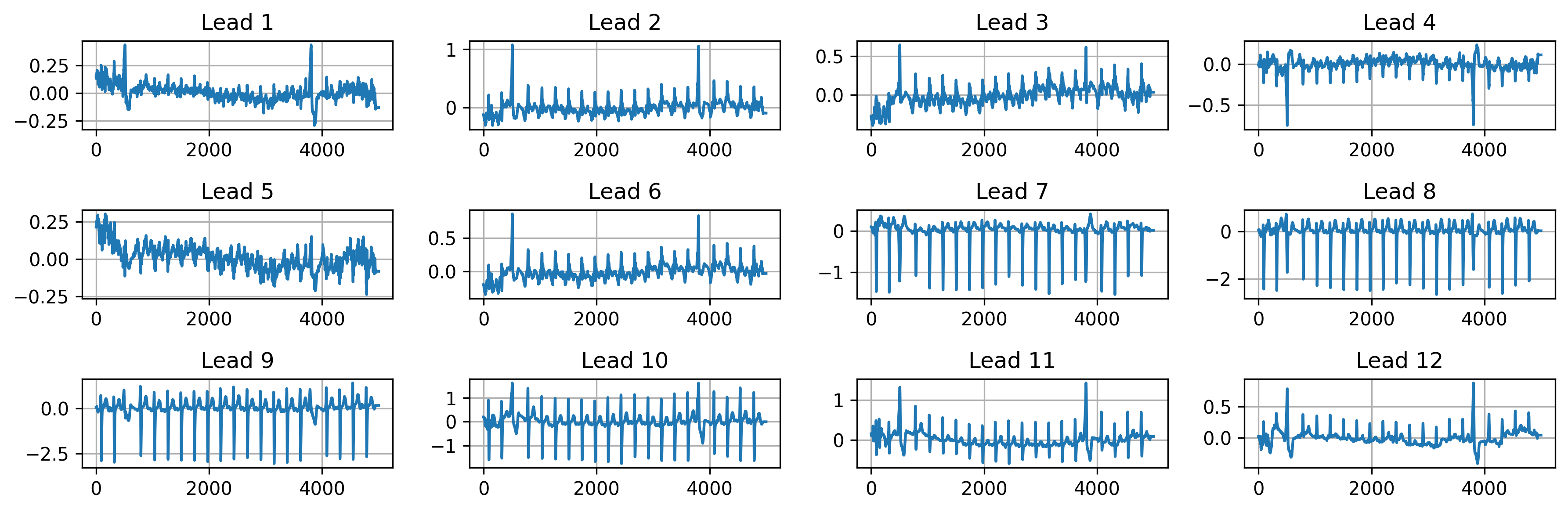 ECG_TRAN Classification Dataset by ekg