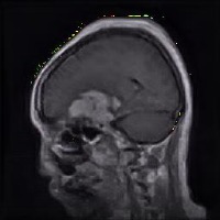 MRI image dataset - Roboflow Universe