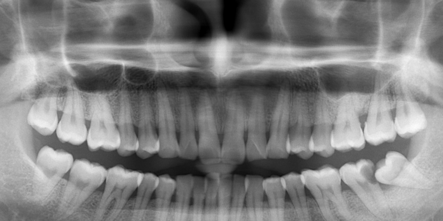 Tooth Segmentation Instance Segmentation Dataset And Pre Trained Model By Azleen 9642