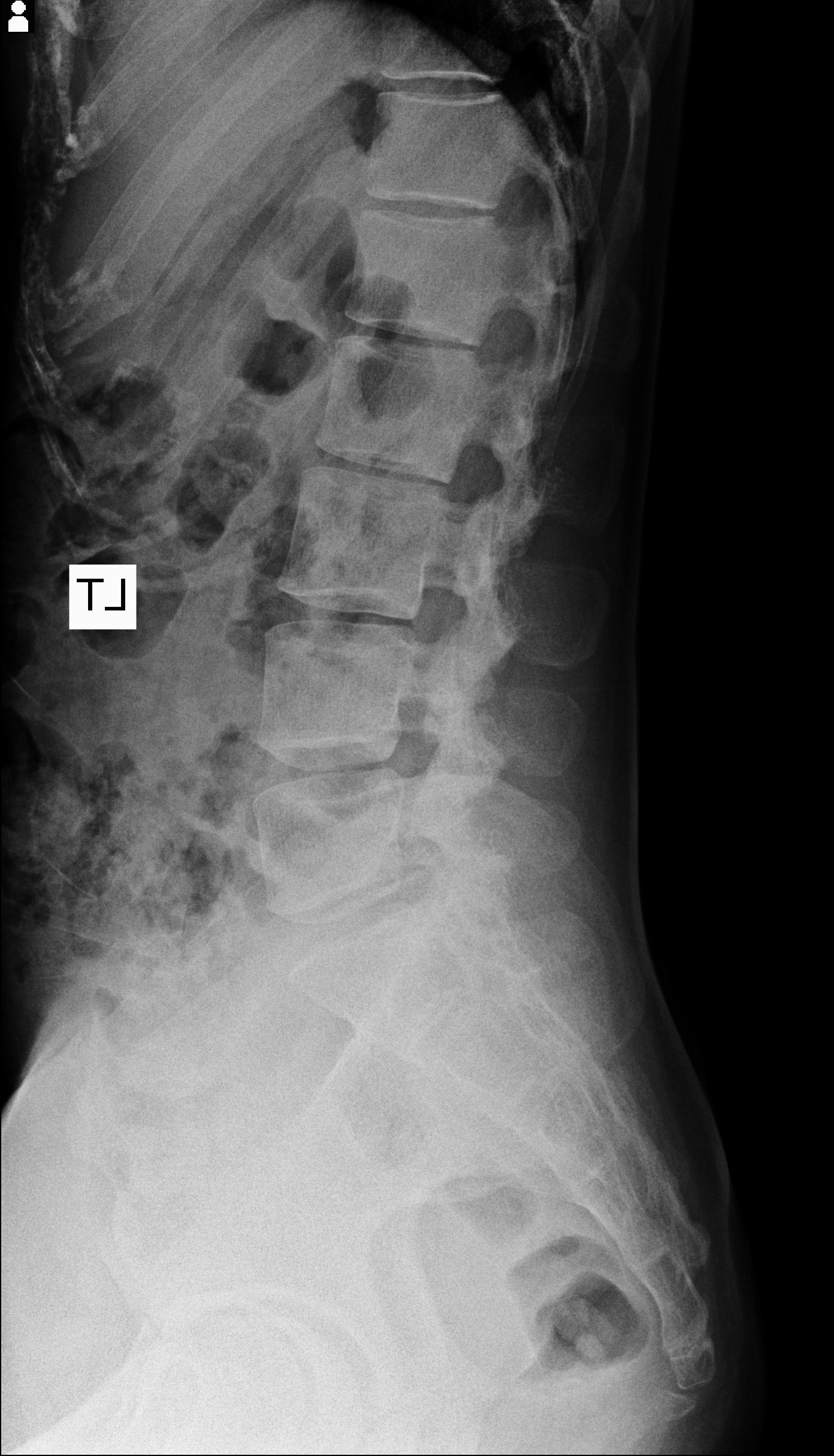 spondy - Roboflow Universe