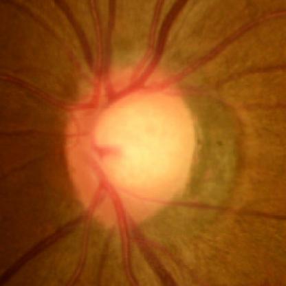 glaucoma detection Classification Model by PSIT