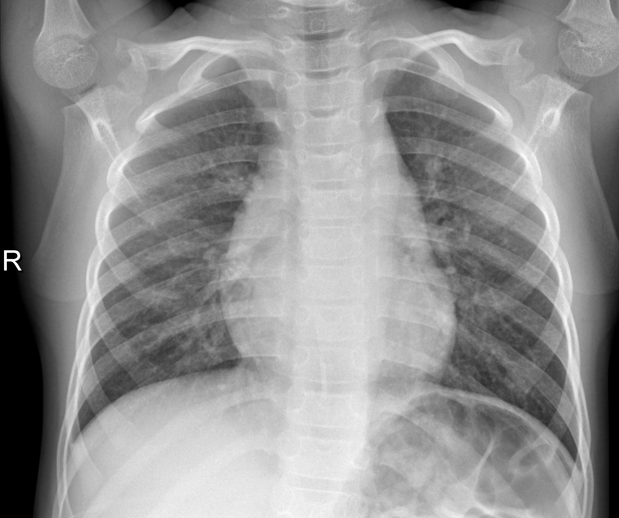 pneumonia Object Detection Model by Annie
