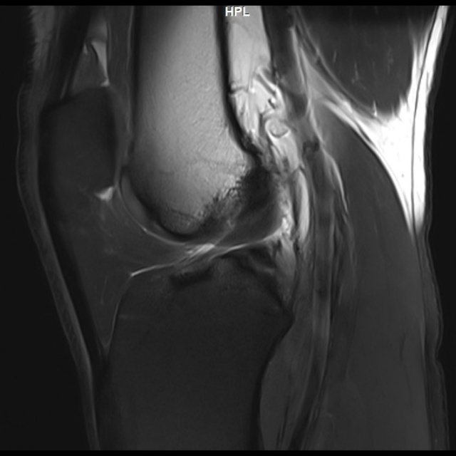 ACL_PCL_Sagittal Object Detection Dataset by Machine Learning