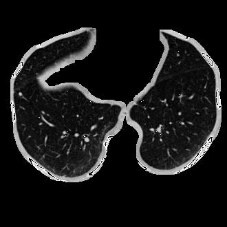 nodule Object Detection Dataset by mm