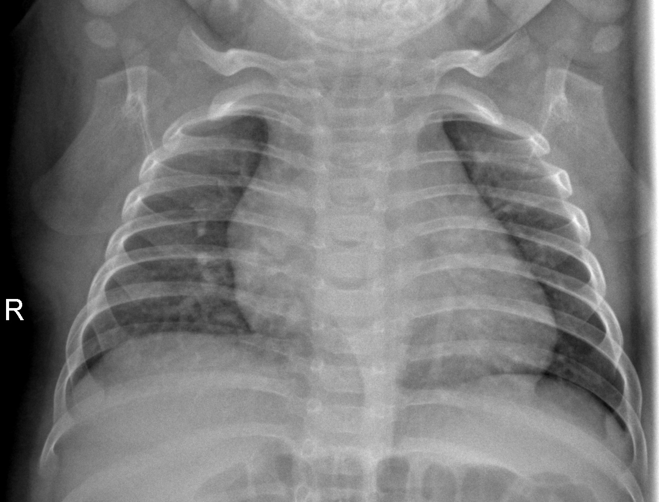 CXR Classification Dataset and Pre-Trained Model by Mahidol University