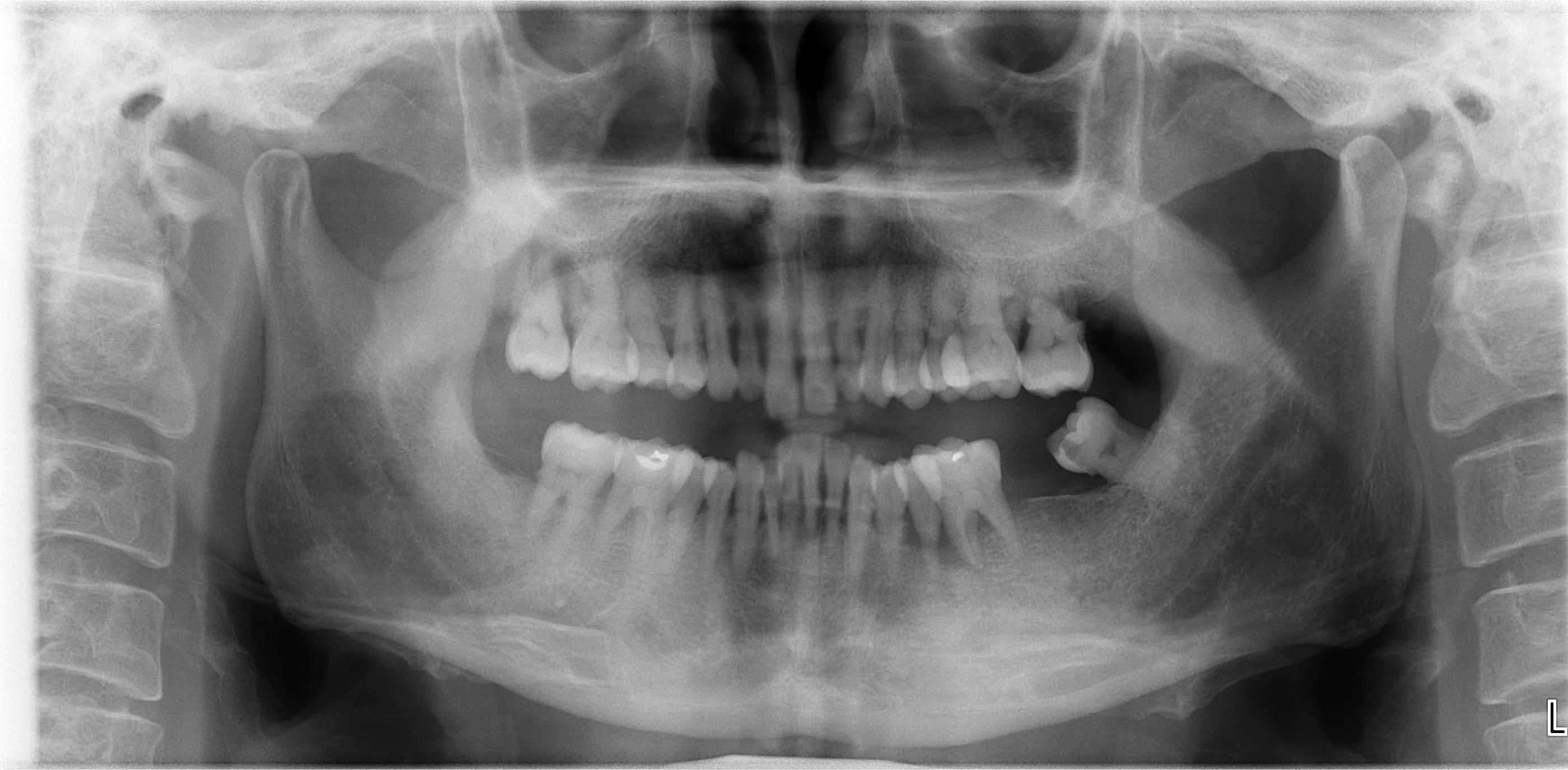Judgment of missing teeth 2 Instance Segmentation Dataset by auto control