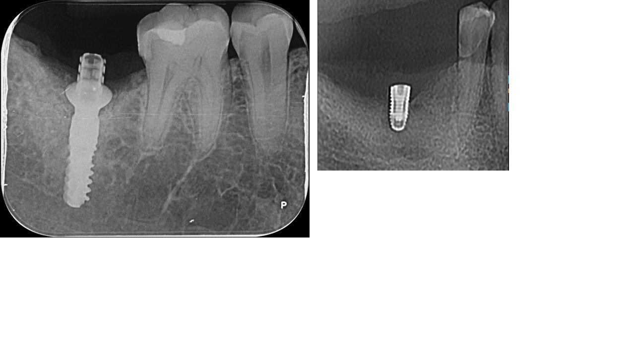 Implants New Version Object Detection Dataset By Tcc Workspace