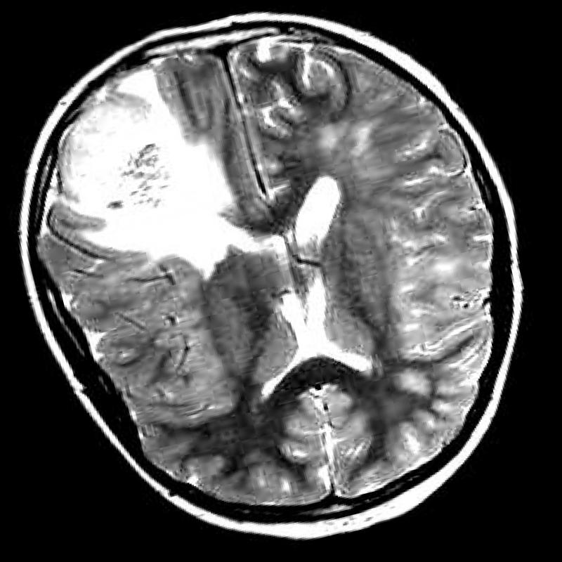 Brain Tumor Segmentation Object Detection Dataset By Dinesh