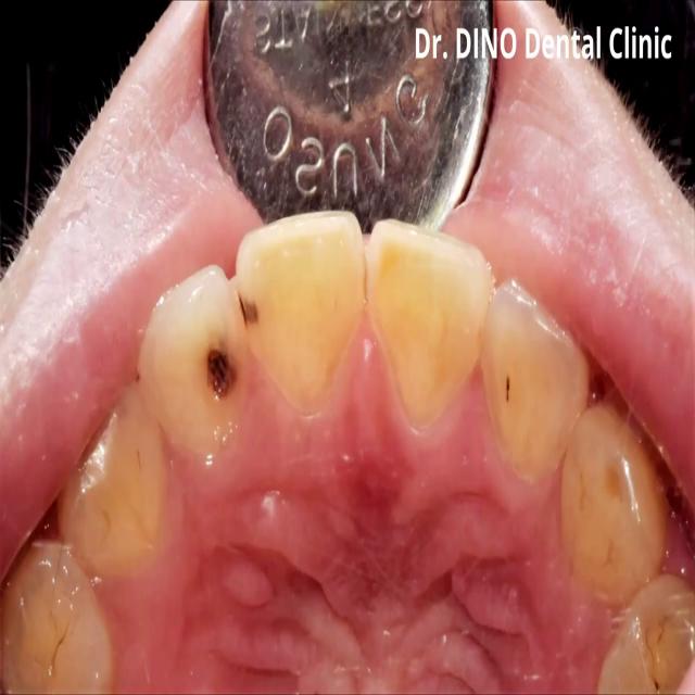 Cavity Object Detection Dataset V3 2023 04 24 1 35pm By Jongboo