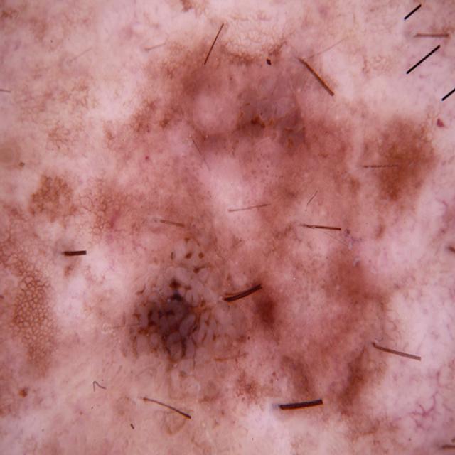 skin cancer detec Object Detection Dataset by PYF Project