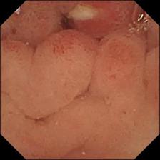 ulcer Instance Segmentation Dataset by medical