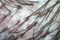 Hair counting - Roboflow Universe