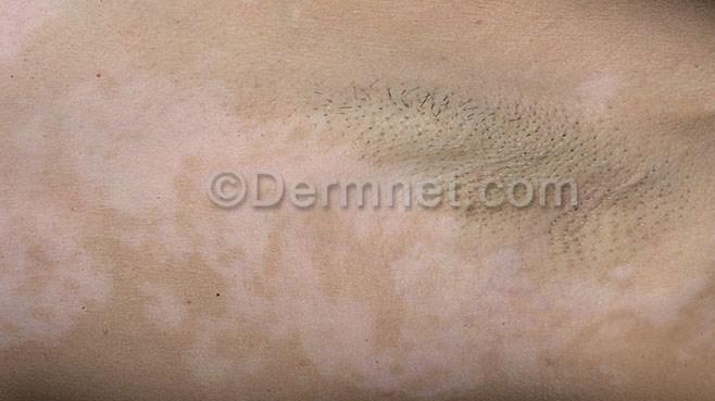 skin-disease-rt2 Classification Dataset by skindisease