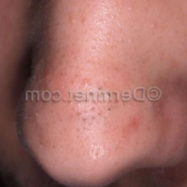 Skin Problems Detection Object Detection Dataset V1 2023 09 25 2 44pm By A